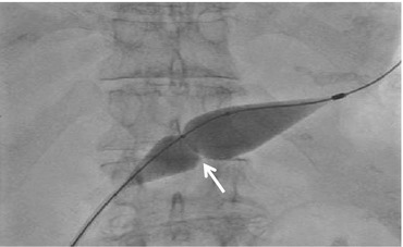 Pericardiocentesis and Balloon Pericardiotomy | SpringerLink