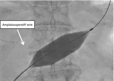Pericardiocentesis and Balloon Pericardiotomy | SpringerLink