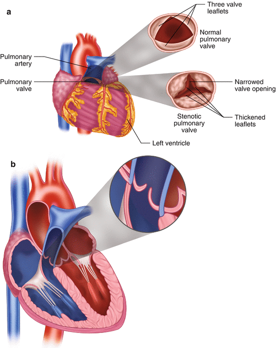Pulmonic Valve: Pulmonic Stenosis | SpringerLink
