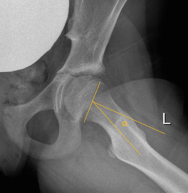 Slipped Capital Femoral Epiphysis | SpringerLink
