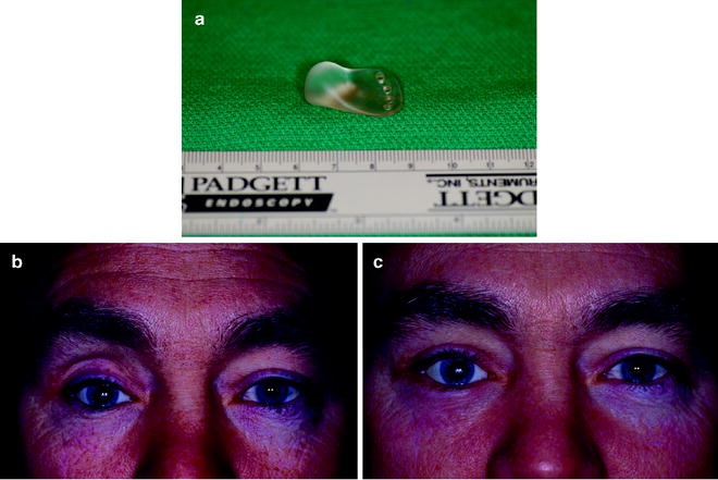Evaluation and Management of the Anophthalmic Socket and Socket ...