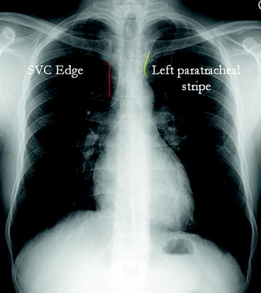 Normal Chest X-Ray, Terminology and Radiographic Anatomy | SpringerLink