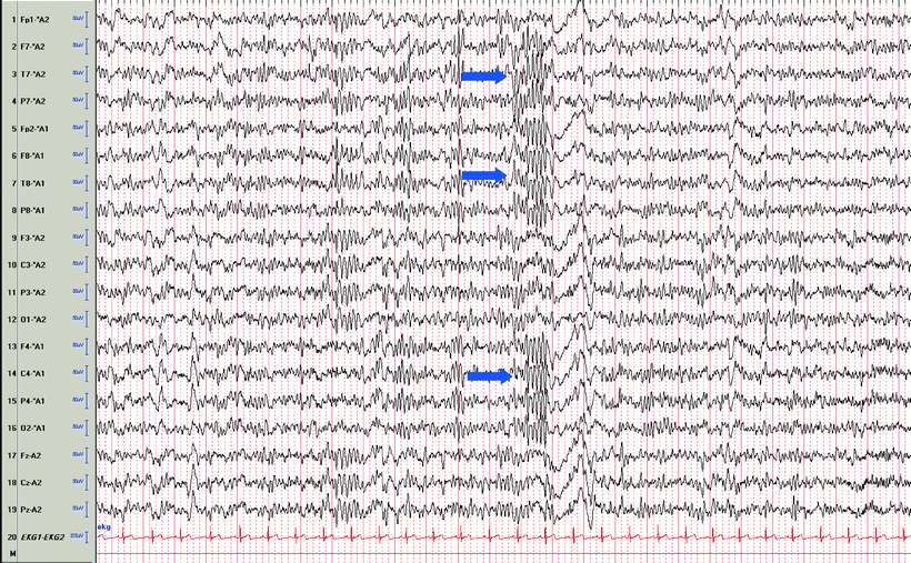 Normal Electroencephalography Variants in Sleep | SpringerLink