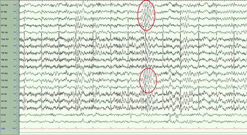 Normal Electroencephalography Variants in Sleep | SpringerLink