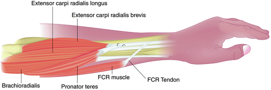 Secondary Procedures for Failed Tendon Transfers | SpringerLink