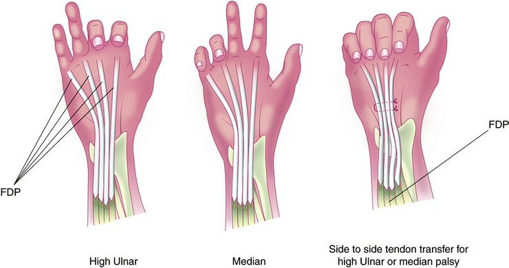 Secondary Procedures for Failed Tendon Transfers | SpringerLink