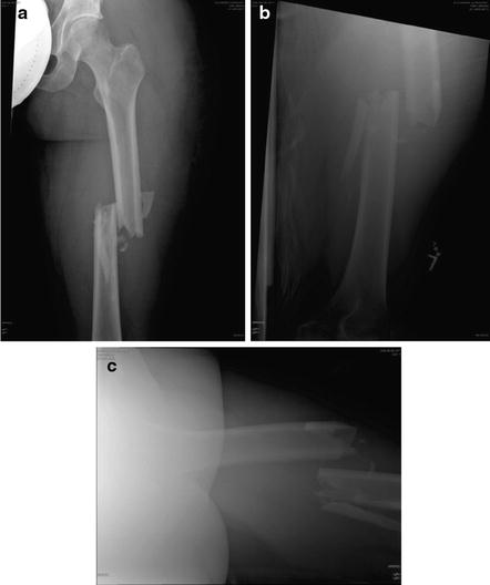 Diaphyseal Femur Fractures | SpringerLink
