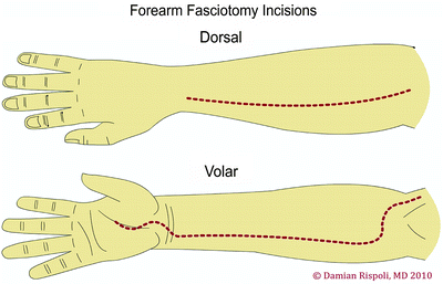 Extremity Compartment Syndromes | SpringerLink