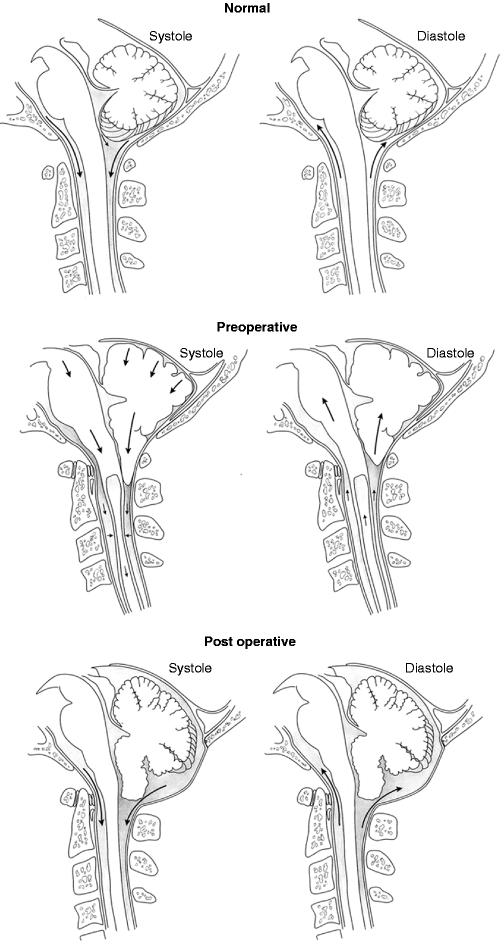 Treatment Of The Adult Chiari I Malformation Springerlink