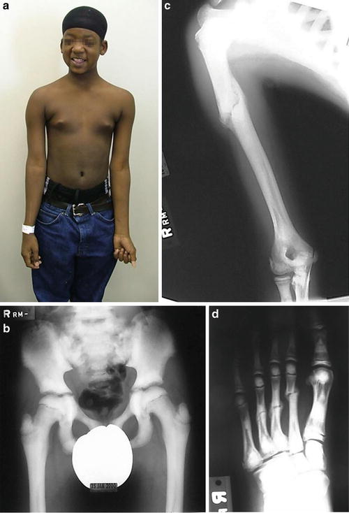 Osteopetrosis | SpringerLink