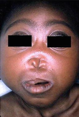 Trisomy 13 Syndrome | SpringerLink