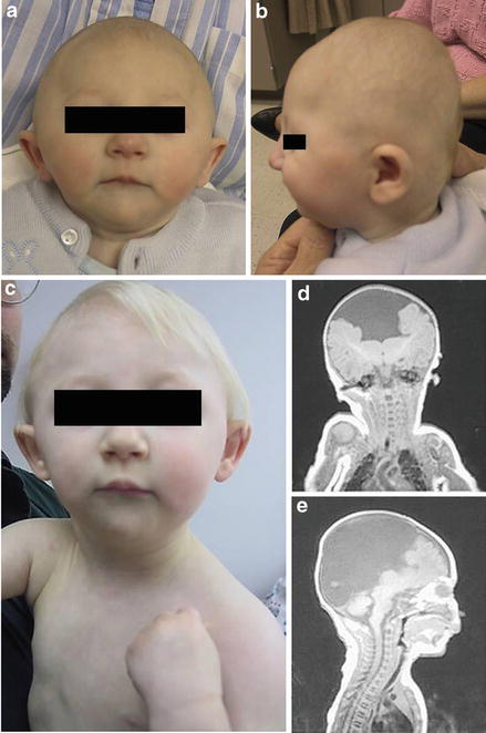 Corpus Callosum Agenesis/Dysgenesis | SpringerLink