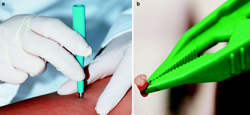 Skin Biopsy | SpringerLink