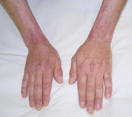 Skin Manifestation in Dermatomyositis | SpringerLink