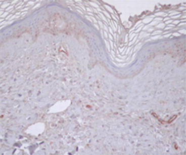 Stiff Skin Syndrome | SpringerLink