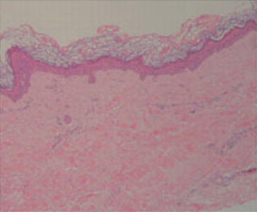 Stiff Skin Syndrome | SpringerLink