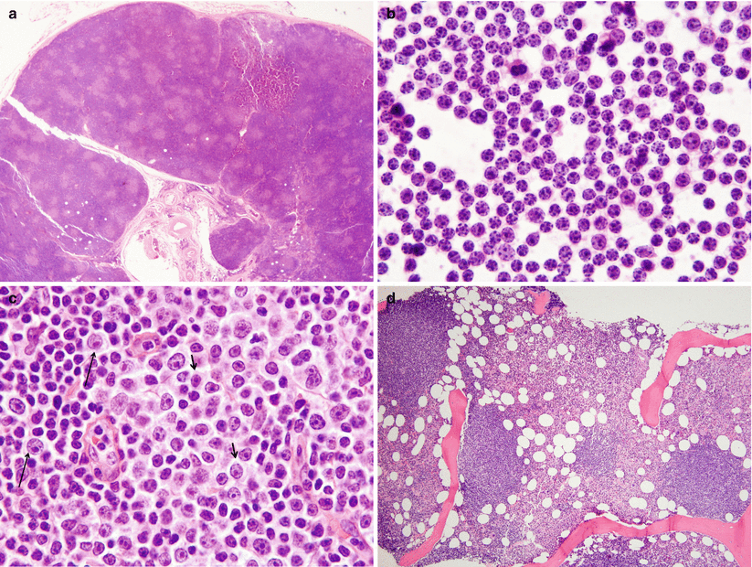 Chronic Lymphocytic Leukemia/Small Lymphocytic Lymphoma | SpringerLink