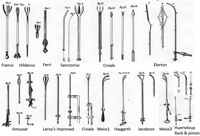 Lithotrity and Litholapaxy | SpringerLink