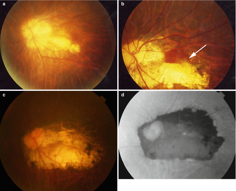 Myopic Chorioretinal Atrophy | SpringerLink