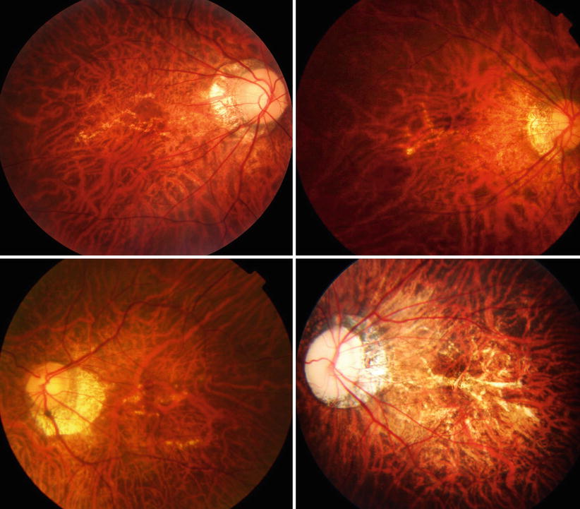 Myopic Chorioretinal Atrophy | SpringerLink