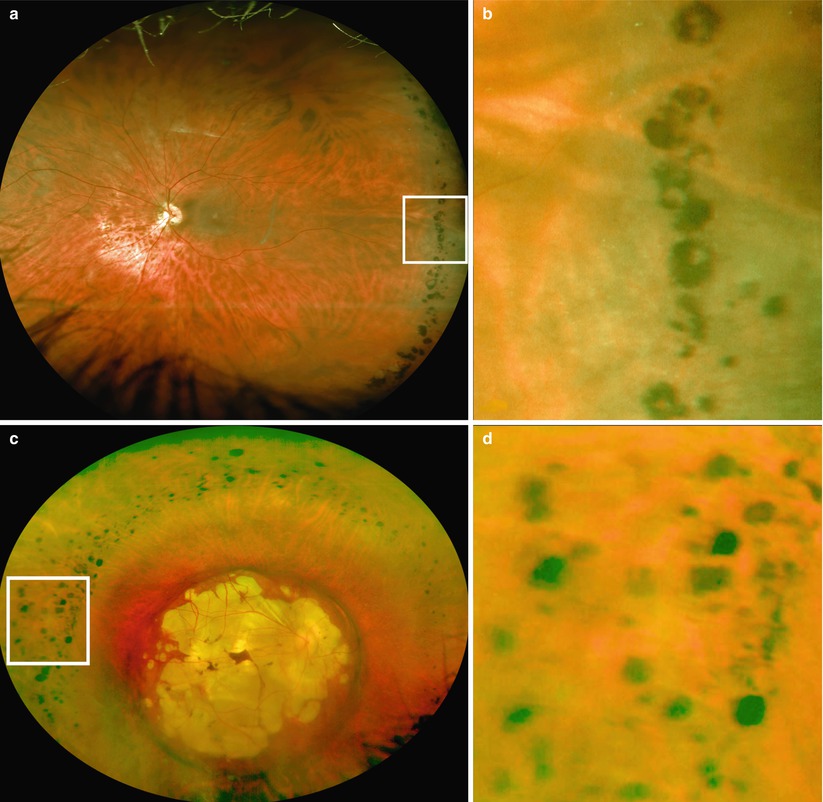 Peripheral Retinal Abnormalities | SpringerLink