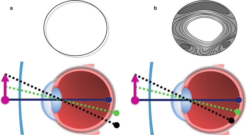 Prevention of Myopia Progression in Children and Adolescents | SpringerLink