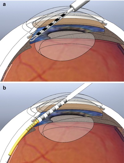 The CyPass Suprachoroidal Micro-Stent | SpringerLink
