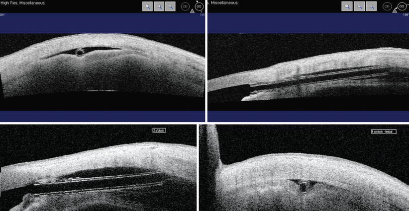 The CyPass Suprachoroidal Micro-Stent | SpringerLink