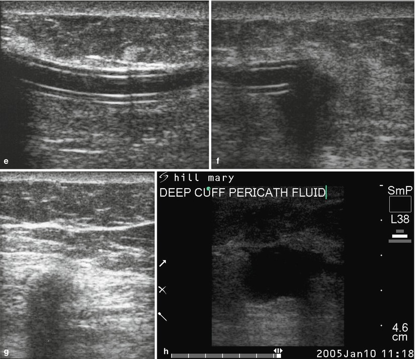 Operative Considerations for Peritoneal Dialysis Catheter | SpringerLink