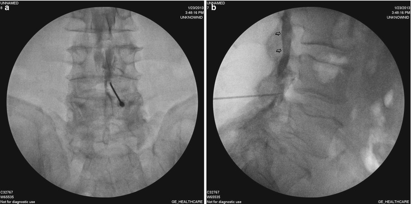 Epidural Blood Patch | SpringerLink