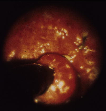 Continent Ileostomy | SpringerLink