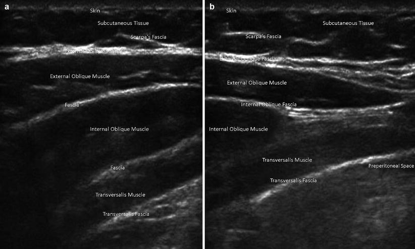 Abdominal Wall Anatomy, Pathology, and Intervention | SpringerLink