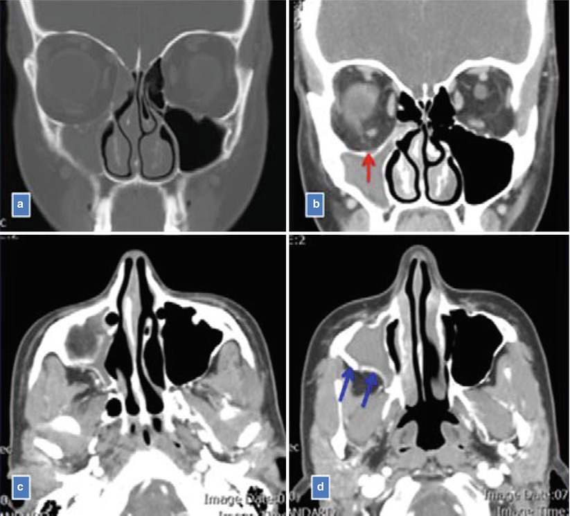 Imaging of the Paranasal Sinuses: Plain-Film Radiography, Computed ...