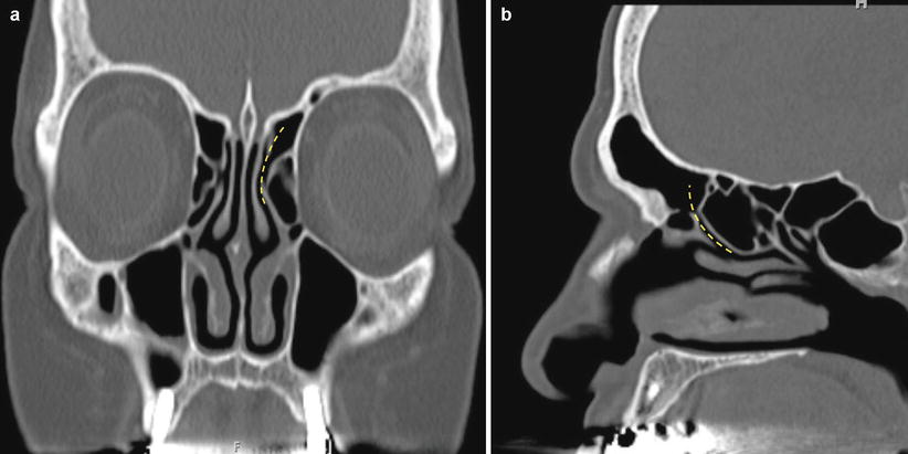Chronic Frontal Sinusitis | SpringerLink