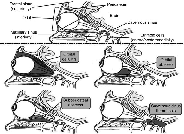 Orbital and Intracranial Complications of Acute and Chronic ...