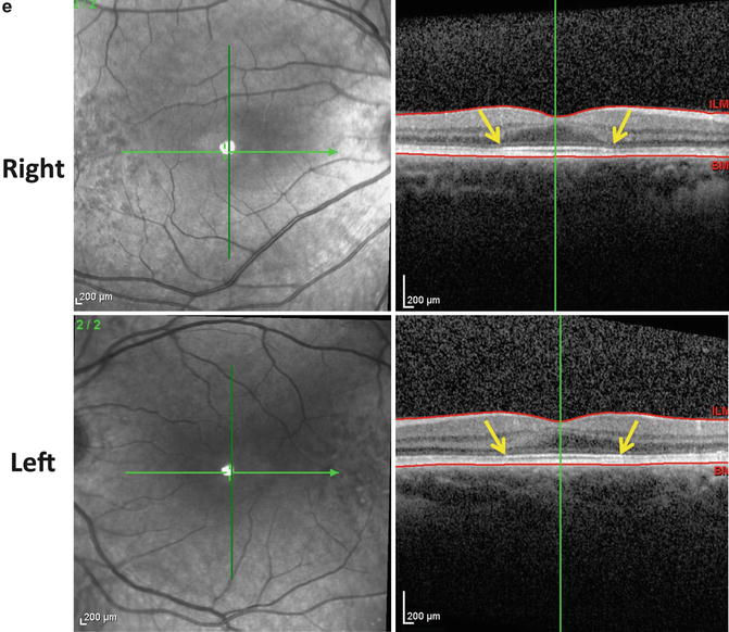 Natural History of Hydroxychloroquine and Chloroquine Retinopathy ...
