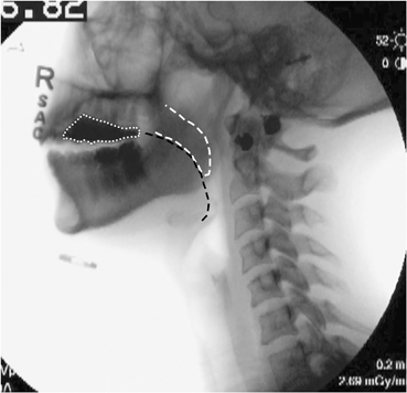 Normal Oral and Pharyngeal Phase Fluoroscopy | SpringerLink