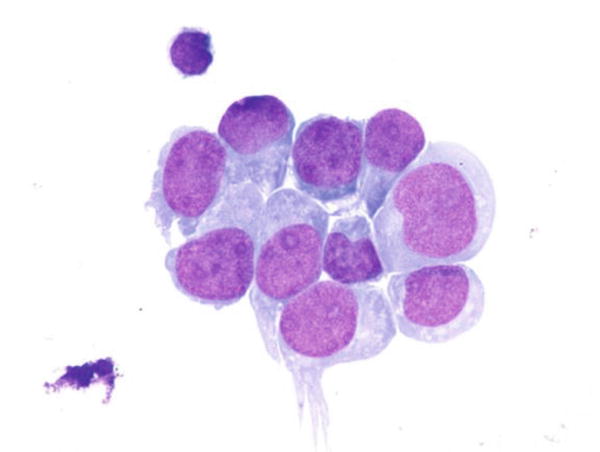 Cerebrospinal Fluid (CSF) Cytology | SpringerLink