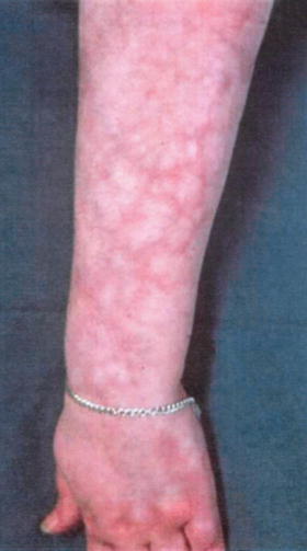 Raynaud’s Mimics | SpringerLink