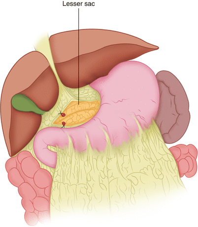Tumor in the Lesser Sac | SpringerLink
