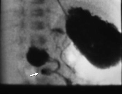 Infant with Bilious Emesis | SpringerLink