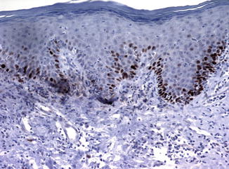 Squamous Intraepithelial Lesions of the Vulva | SpringerLink