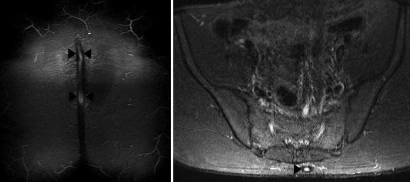 MRI for Perianal Fistula | SpringerLink