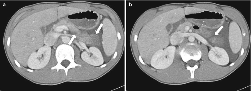The Extraperitoneal Spaces | SpringerLink