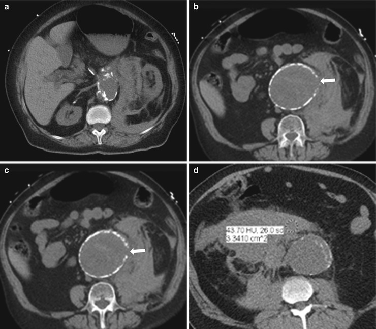 The Extraperitoneal Spaces | SpringerLink