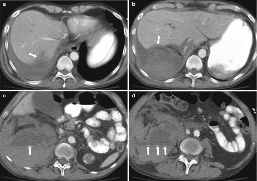 The Extraperitoneal Spaces | SpringerLink