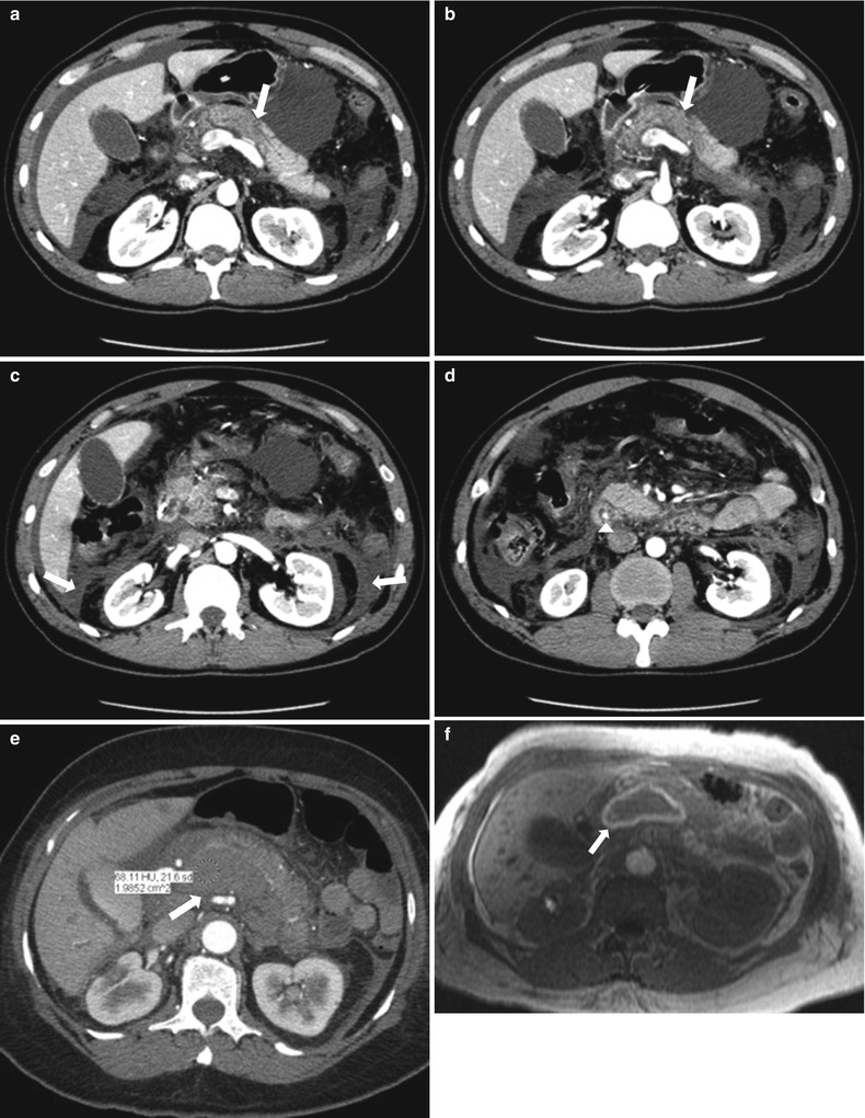 The Extraperitoneal Spaces | SpringerLink