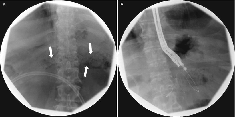 The Extraperitoneal Spaces | SpringerLink