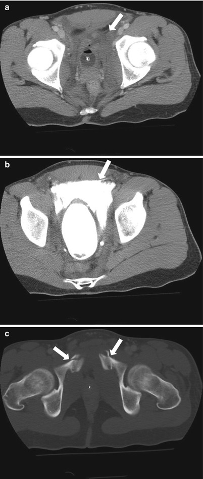 The Extraperitoneal Spaces | SpringerLink
