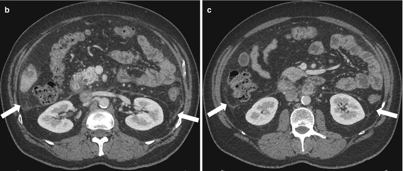 The Extraperitoneal Spaces | SpringerLink
